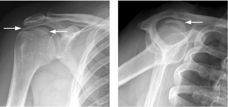 Calcific Tendinitis of the Shoulder - OrthoInfo - AAOS