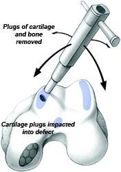 Articular Cartilage Restoration - OrthoInfo - AAOS