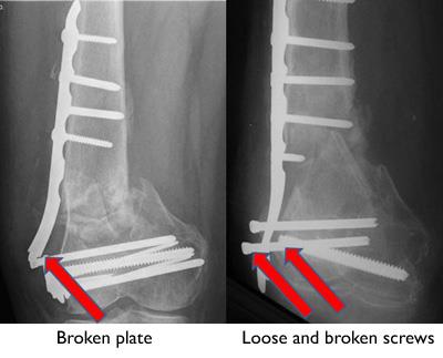 Distal Femur (Thighbone) Fractures of the Knee - OrthoInfo - AAOS