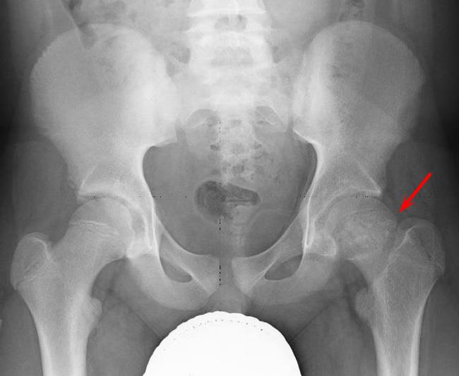 Slipped Capital Femoral Epiphysis - OrthoInfo - AAOS