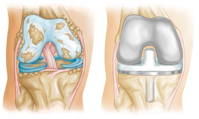 Knee Replacement Implants OrthoInfo AAOS