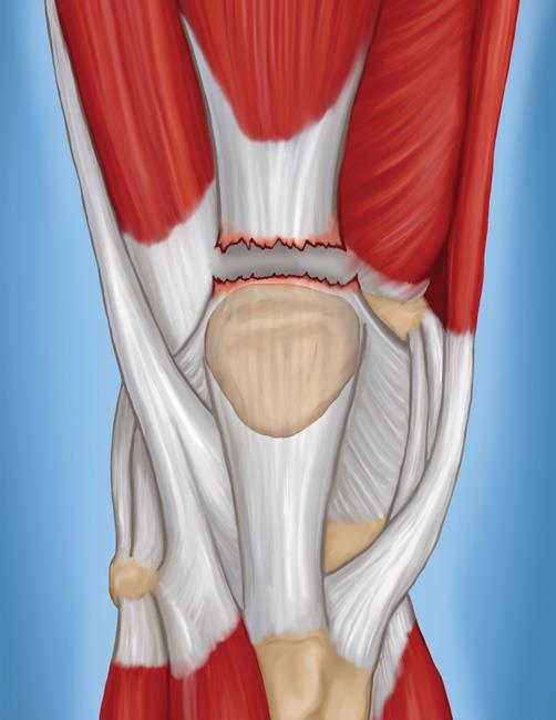 Quadriceps Tendon Tear OrthoInfo AAOS 2022 