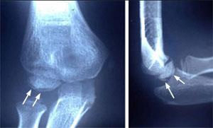 Throwing Injuries in the Elbow in Children - OrthoInfo - AAOS
