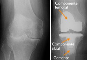 Reemplazo total de rodilla (Total Knee Replacement) - OrthoInfo - AAOS