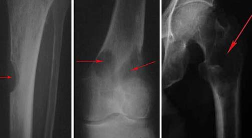 Multiple Myeloma/Plasmacytoma - OrthoInfo - AAOS