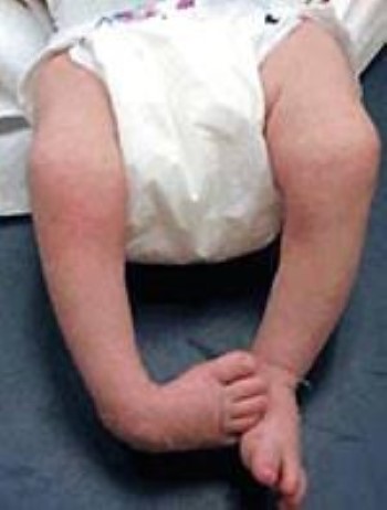 Clubfoot - OrthoInfo - AAOS