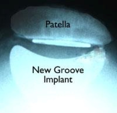 Patellofemoral Arthritis - OrthoInfo - AAOS