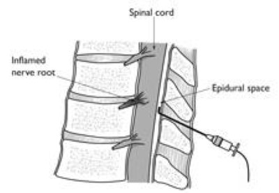 Spinal Injections - OrthoInfo - AAOS
