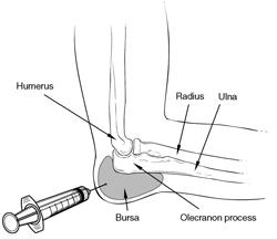 Elbow (Olecranon) Bursitis - OrthoInfo - AAOS