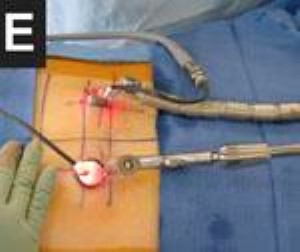 Minimally Invasive Spine Surgery - OrthoInfo - AAOS