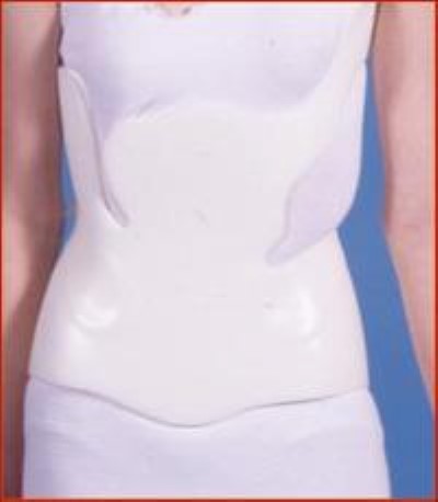 Idiopathic Scoliosis in Children and Adolescents - OrthoInfo - AAOS