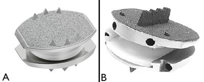 Artificial Disk Replacement in the Lumbar Spine - OrthoInfo - AAOS