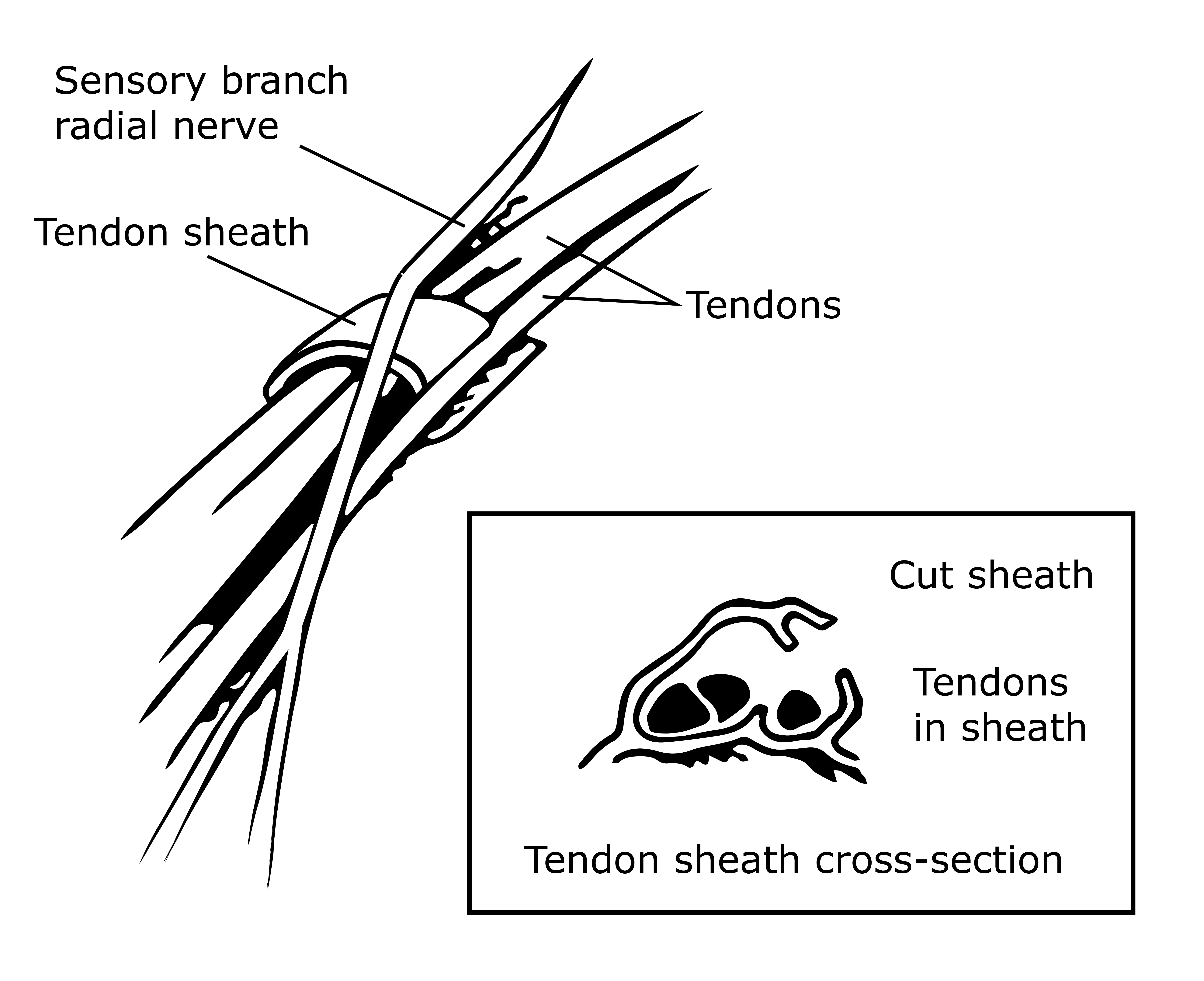 De Quervain's Tenosynovitis Symptoms and Treatment - OrthoInfo - AAOS
