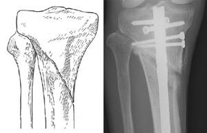 Fractures of the Proximal Tibia (Shinbone) - OrthoInfo - AAOS