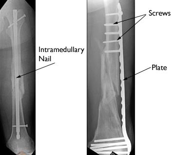 Internal Fixation for Fractures - OrthoInfo - AAOS