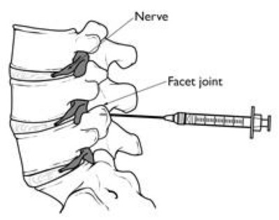 Spinal Injections - OrthoInfo - AAOS