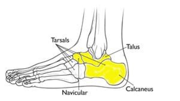 Tarsal Coalition - OrthoInfo - AAOS