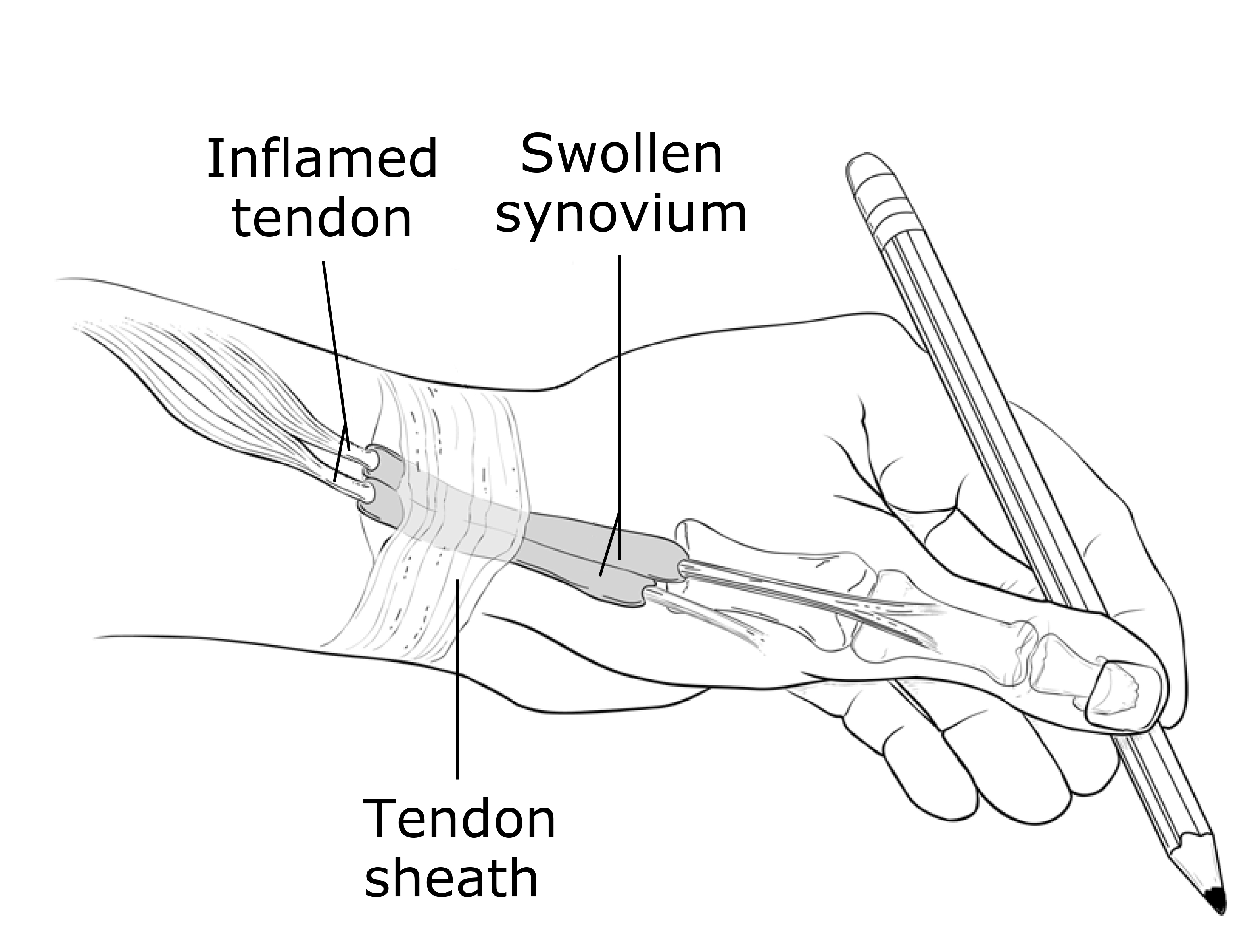 De Quervain s Tendinosis Symptoms And Treatment OrthoInfo AAOS