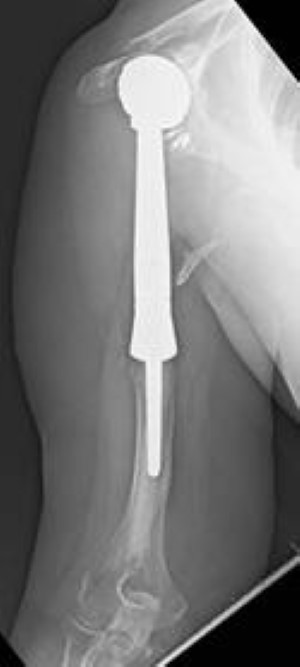 Treatment for Metastatic Bone Disease - OrthoInfo - AAOS