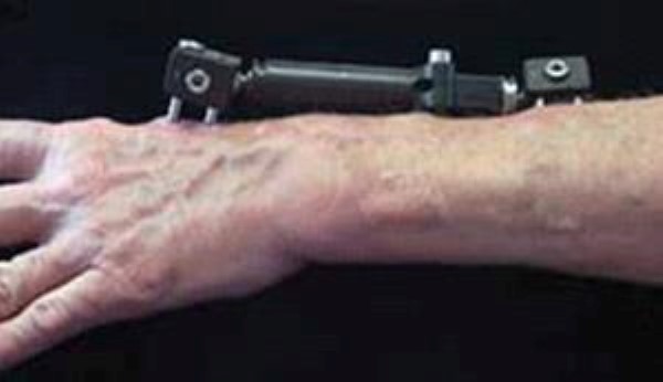 Distal Radius Fractures (Broken Wrist) - OrthoInfo - AAOS