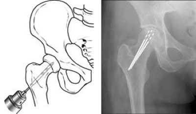 Osteonecrosis of the Hip - OrthoInfo - AAOS