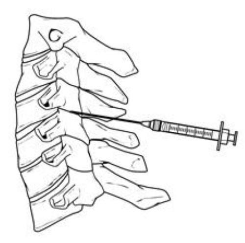 Spinal Injections - OrthoInfo - AAOS