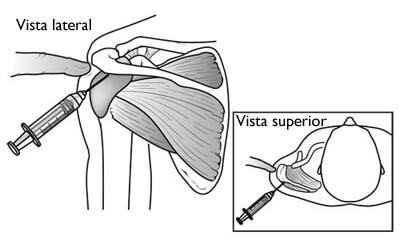 Compresión del hombro/ Tendinitis del manguito rotador (Shoulder ...