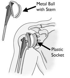 Shoulder Joint Replacement - OrthoInfo - AAOS
